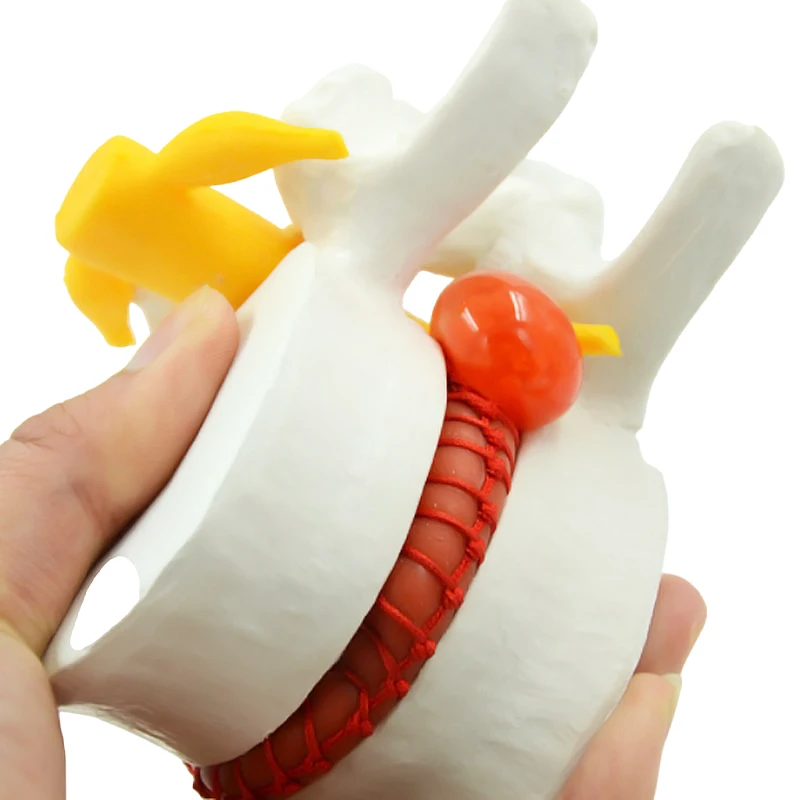 Human-Anatomy-Skeleton-Spine-Lumbar-Disc-Herniation-Teaching-Model ...