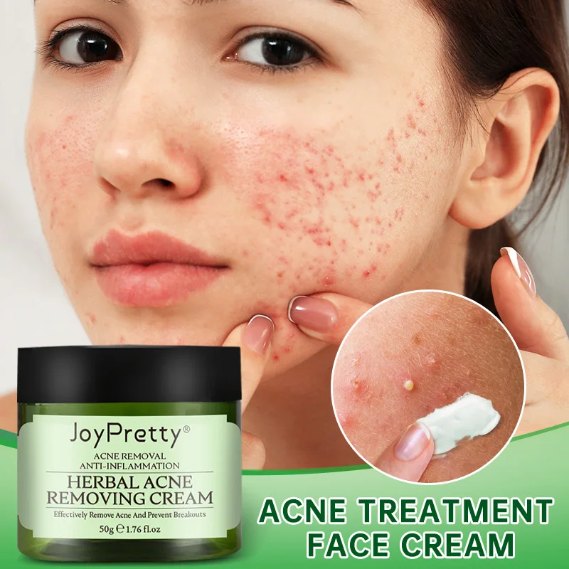 JoyPretty-crema-Facial-hidratante-para-el-acn-tratamiento-para-el ...