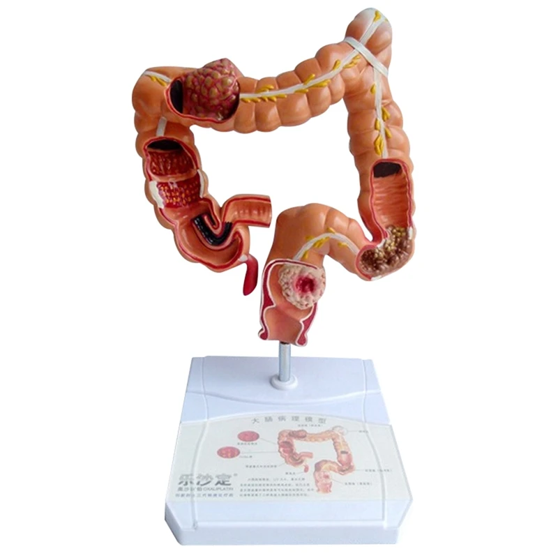 Teaching-Model-Human-Large-Intestine-Anatomy-Model-Visceral-Lesion ...