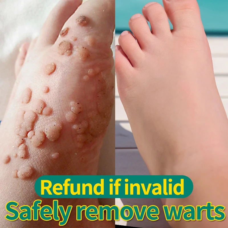 How To Get Rid Of Warts On Neck