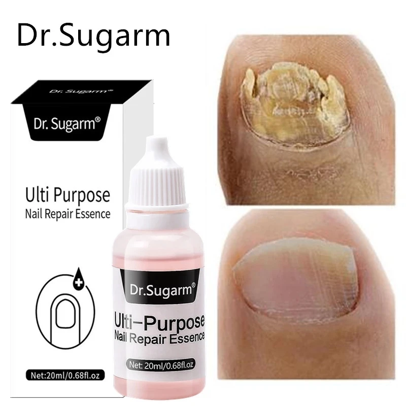 Dr.Sugarm Nagel Pilz Behandlung Serum Paronychie Anti Infektion Zehe ...