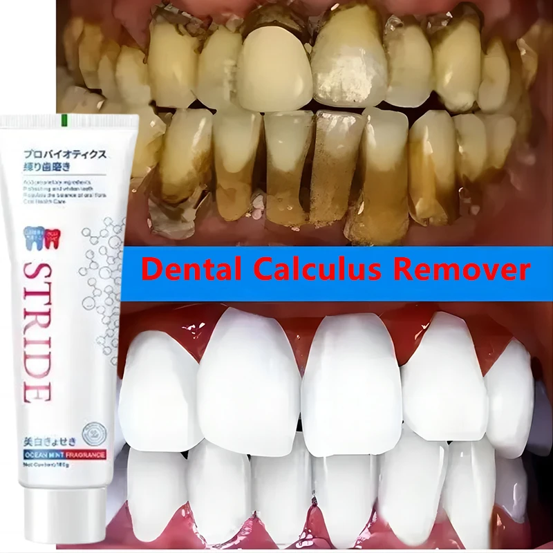 Dental-Calculus-Remover-Whitening-Teeth-Mousse-Toothpaste-Mouth-Odour ...