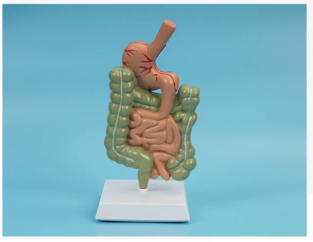 Maag Model Anatomie Gi Tract Model Zieke Spijsvertering Maag Anatomie
