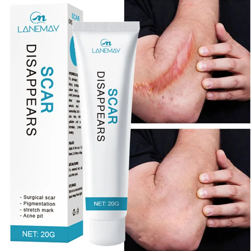 Littekenverwijderingscr-me-Reparatie-Striae-Burn-Acne-Chirurgische-Acne ...