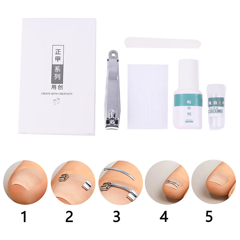 Ingrown-Toenail-Correction-Tools-Professional-Treatment-Recover-Embed ...