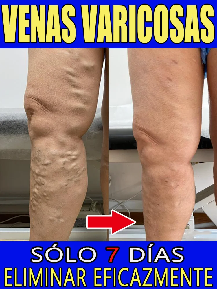 Pomada-efectiva-para-aliviar-las-venas-varicosas-crema-para-aliviar-la ...