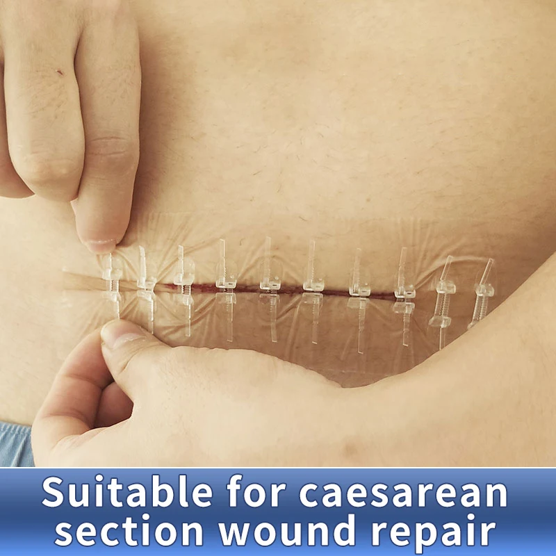 Zipper-Band-aid-Suture-free-Wound-Dressing-Patches-Painless-Wound ...