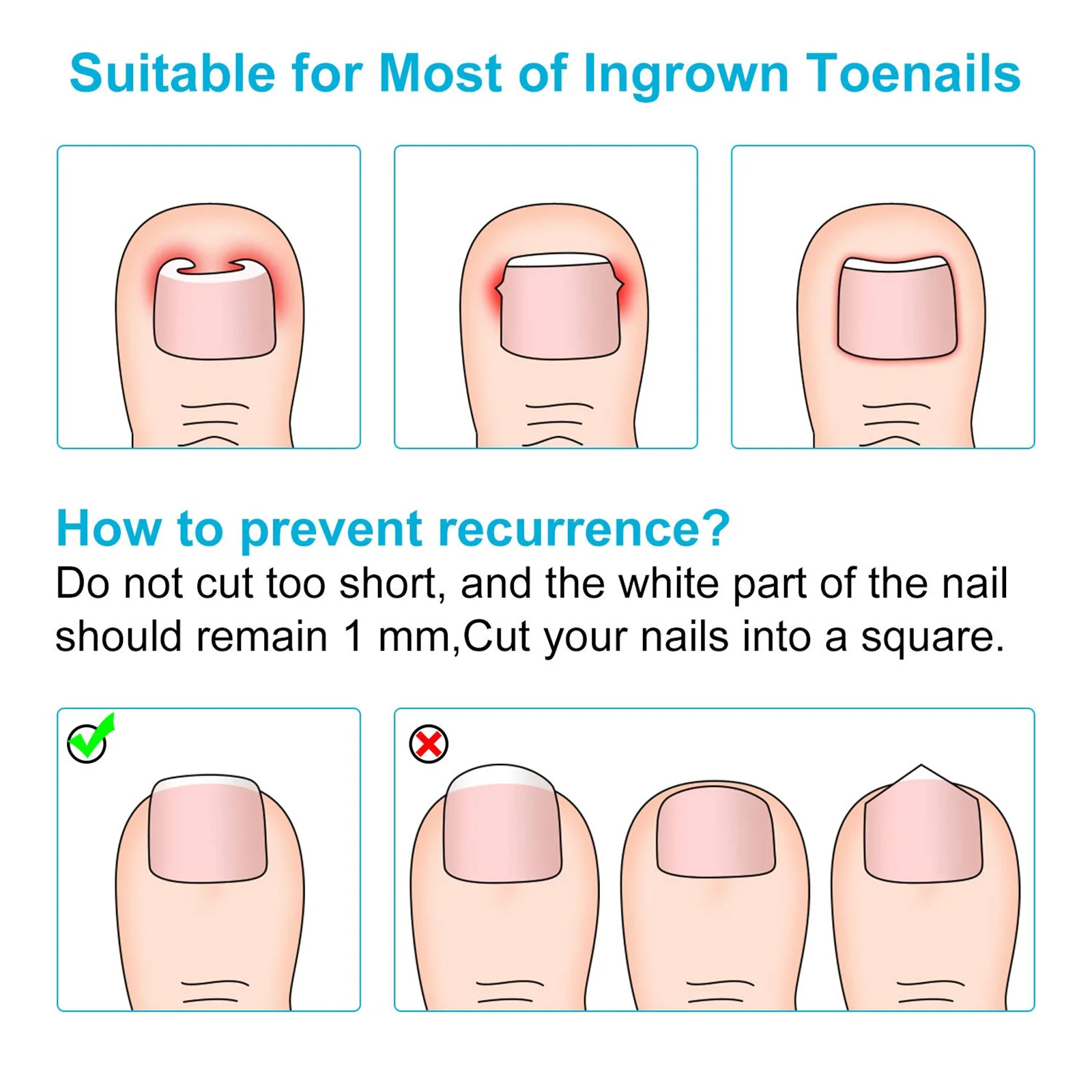 Generic Toenail Ingrown Corrector Correction Brace Tape Toenails Tool ...