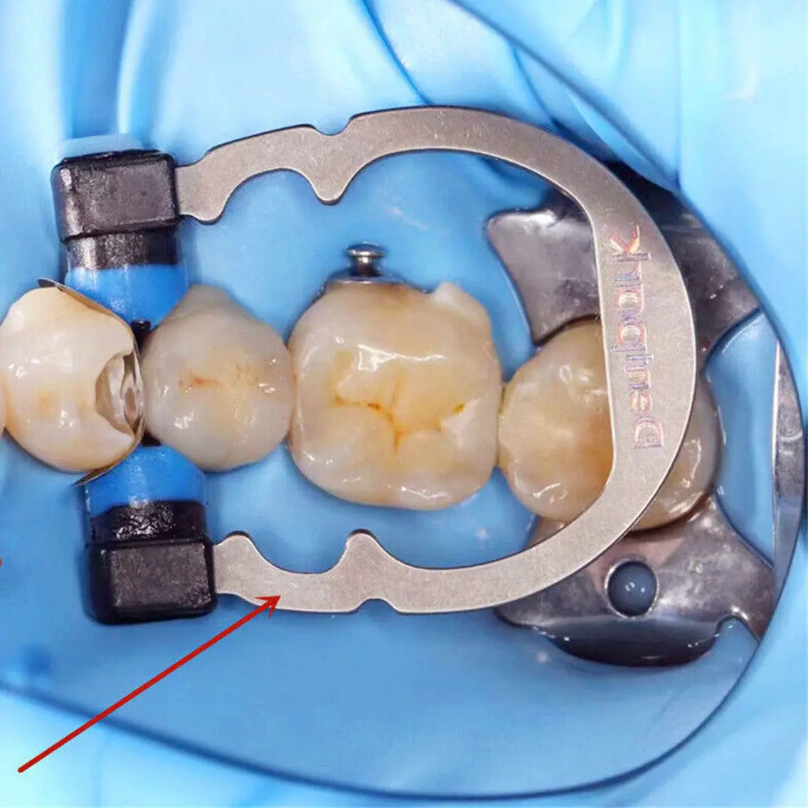 Palodent Matrix System