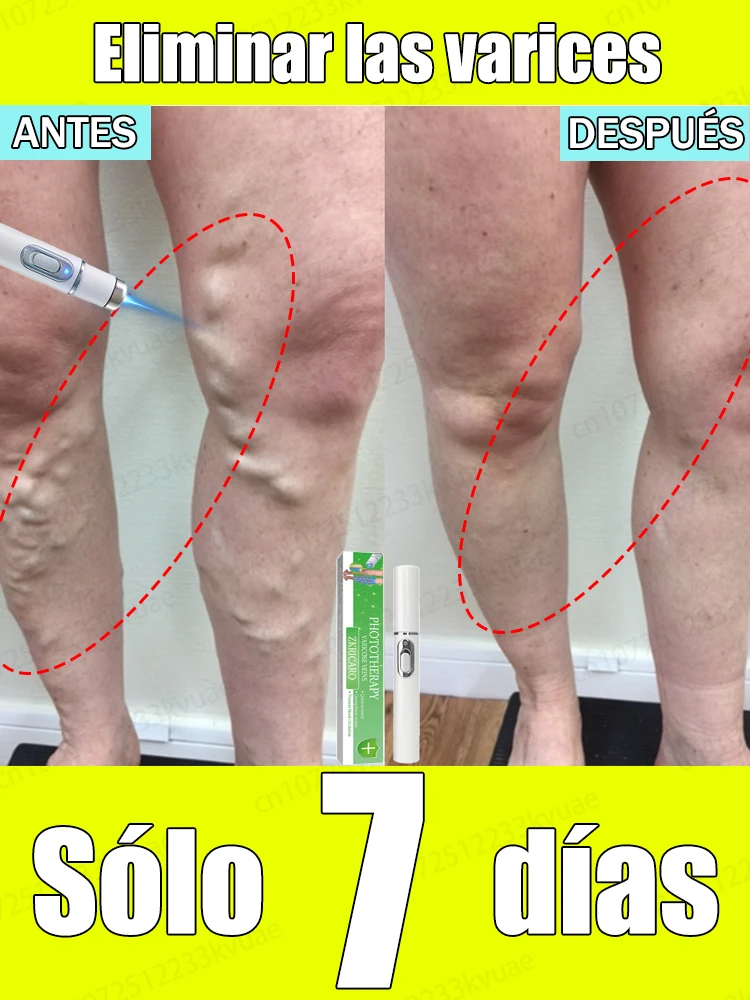 Eliminar-varices-seguro-y-efectivo-tratamiento-l-ser-para-varices.jpg