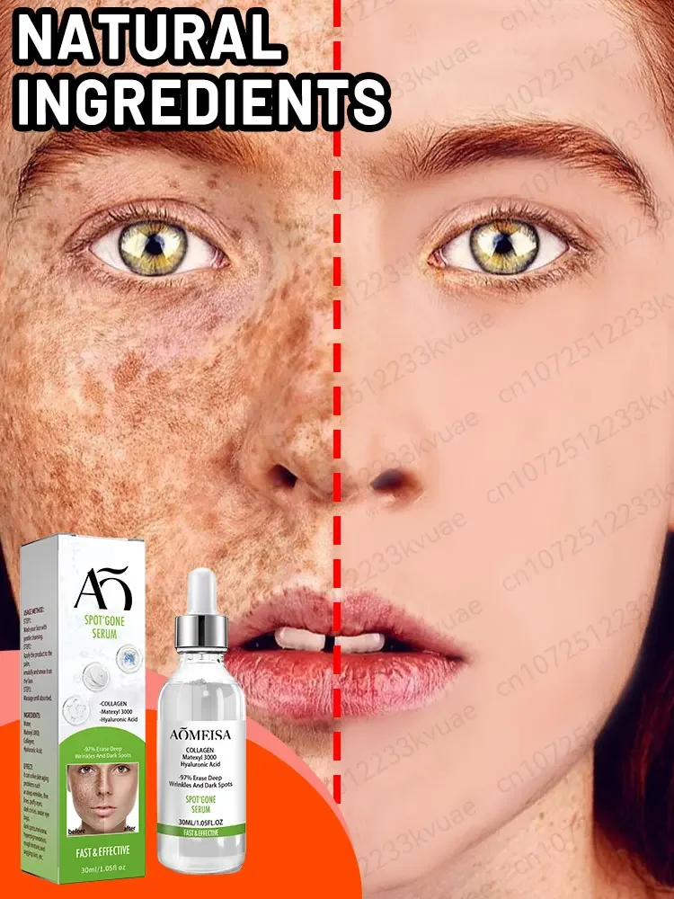Dark-Spot-Remover-Melasma-Chloasma-Freckles-Spot-Removal-Lighten-Skin ...