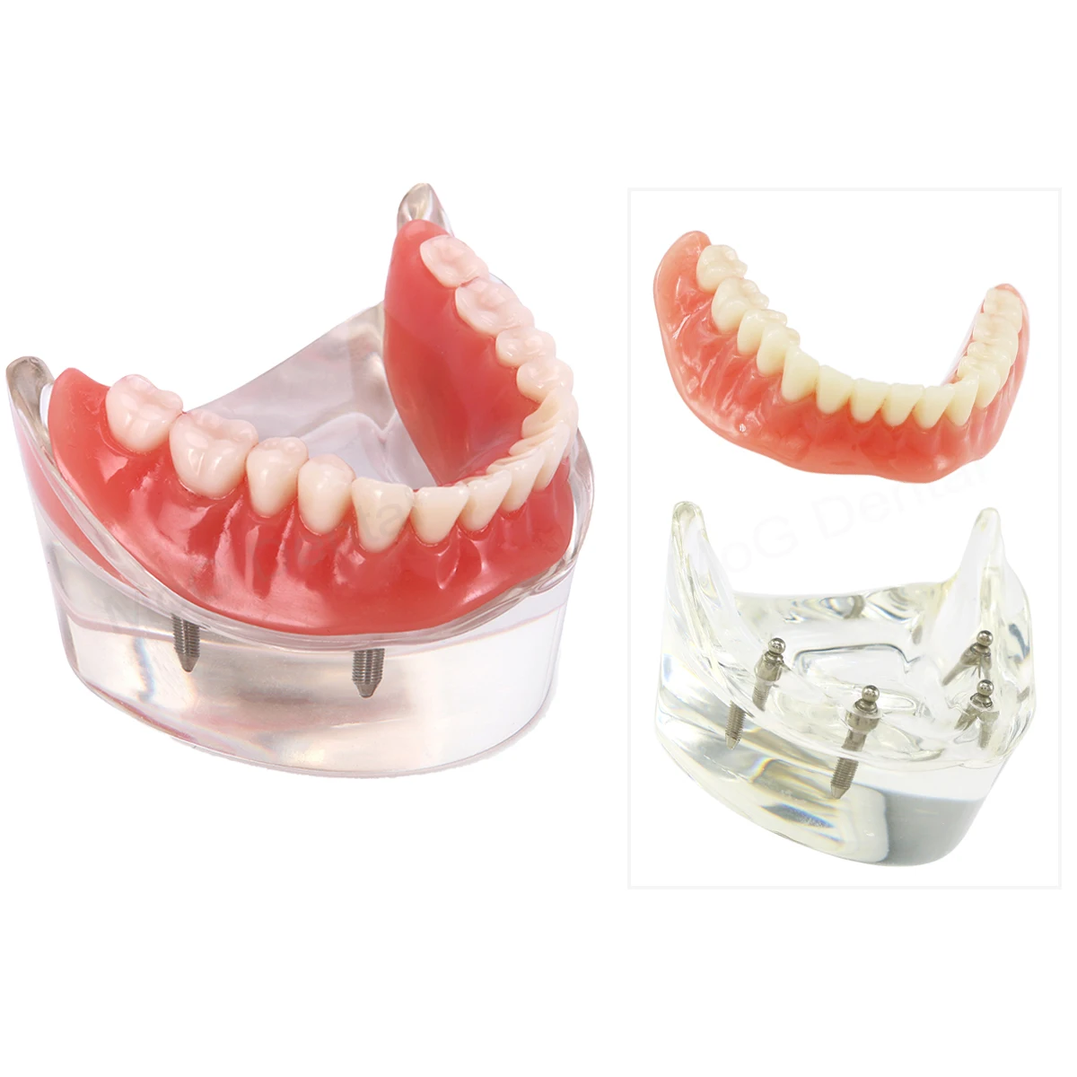 Dental-Implant-Teeth-Model-with-Overdenture-Inferior-Demo-4-Implants ...