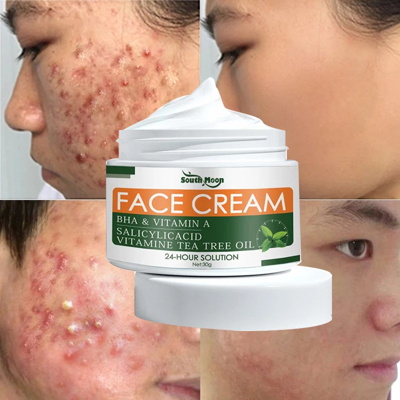 Effective-Acne-Removal-Face-Cream-Herbal-Anti-Acne-Gel-Shrink-Pores-Oil ...