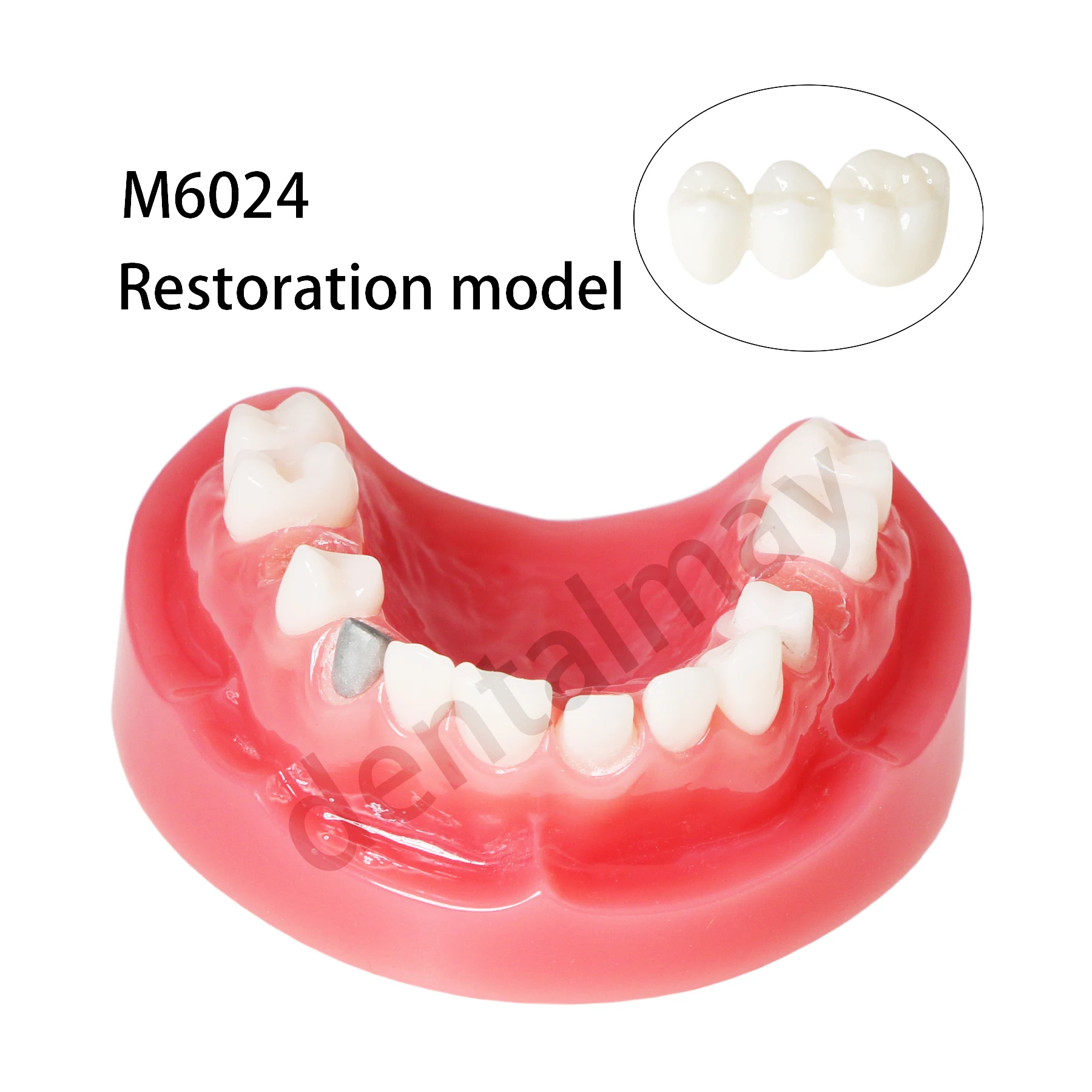 Dental-Teeth-Model-Implant-Restoration-Typodont-Model-with-Post-Core ...