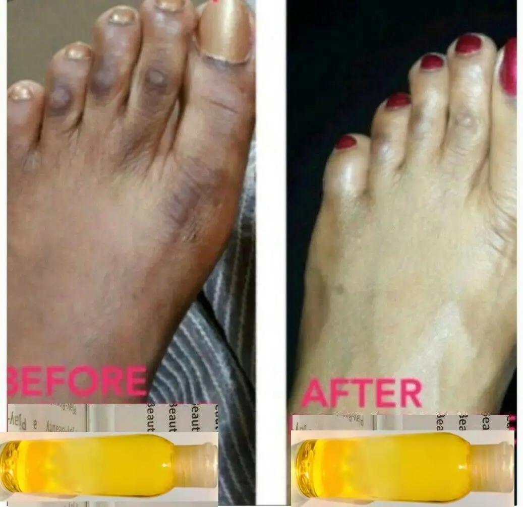 Fast-DARK-KNUCKLES-DARK-FEET-KNEE-SOLUTION-ORIGINAL-YELLOW-PEELING-OIL ...