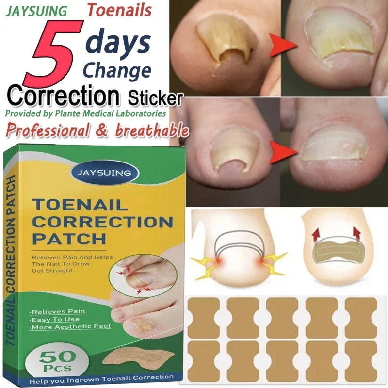 50pcs-Nail-Correction-Stickers-Ingrown-Toenail-Corrector-Patches ...