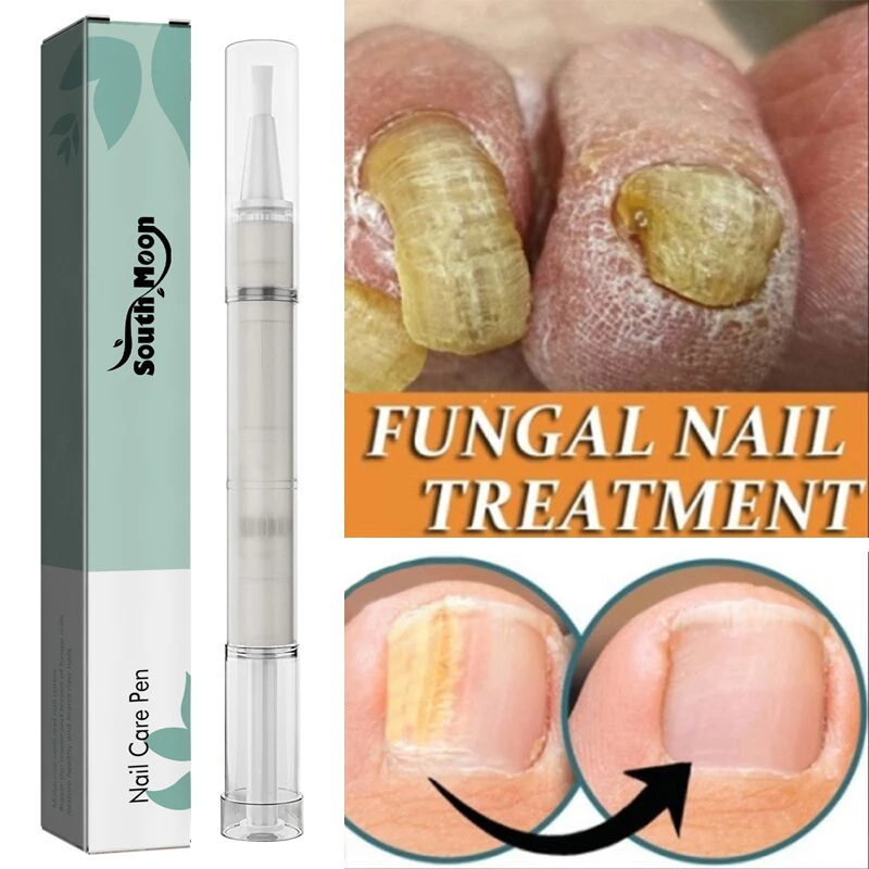 Pluma de tratamiento de hongos para uñas, suero antiinfección para ...