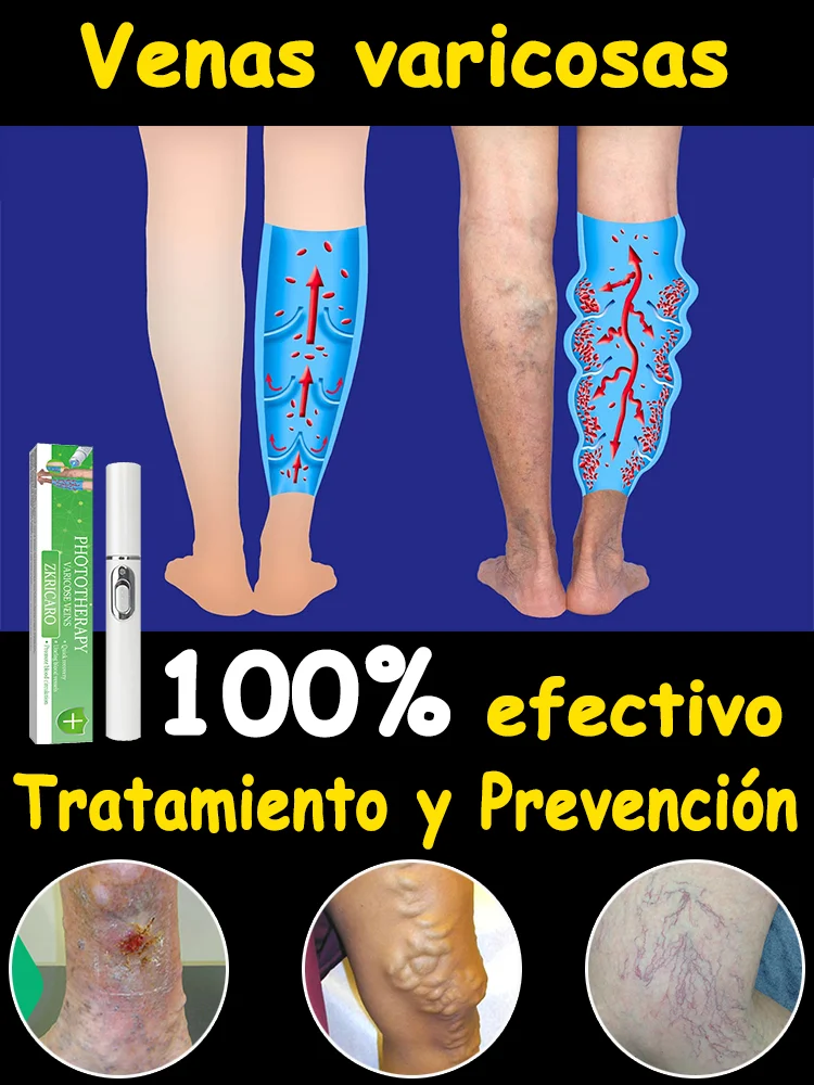 Terapia-con-l-ser-para-varices-en-hombres-y-mujeres-aliviando-el-dolor ...