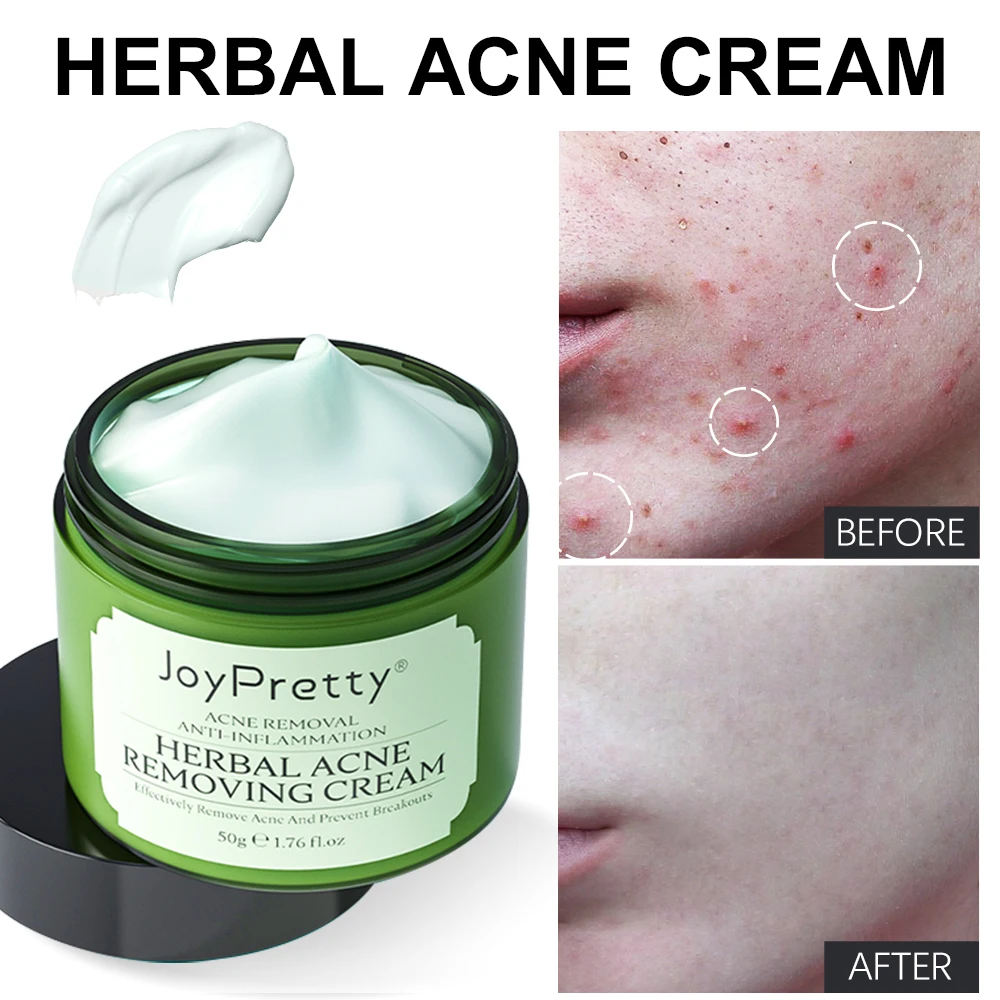 Herbal-Acne-Face-Cream-Pimple-Marks-Removal-Oil-Control-Moisturizing-Pockmark-Smooth-Facial ...