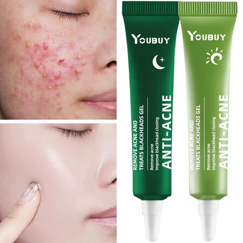 Acne-Cream-Whitening-Day-Night-Effective-Whitening-Repair-Spots-Gel-Oil ...