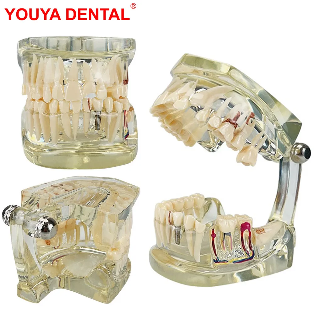 Anatomy-Dental-Model-Teeth-Teaching-Model-Transparent-Jaw-Model ...