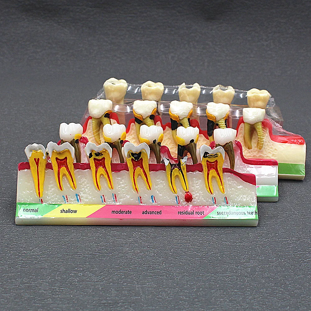 Dental-Periodontal-Disease-Model-Caries-Fault-Display-Teaching ...