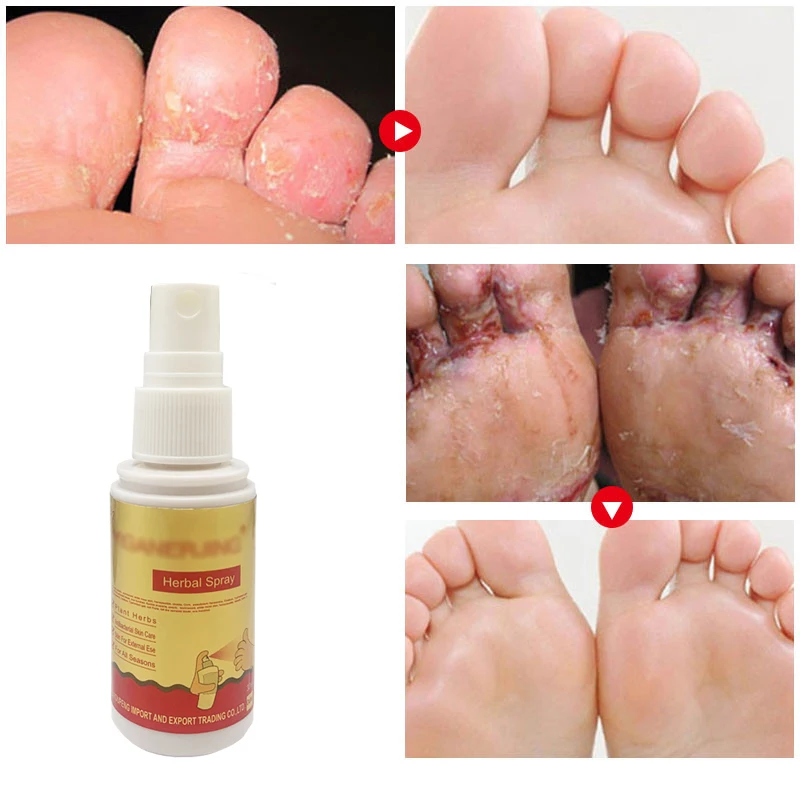 Foot-Anti-fungal-Spray-Remove-Herbal-Athlete-Foot-Odor-Beriberi-Itching ...