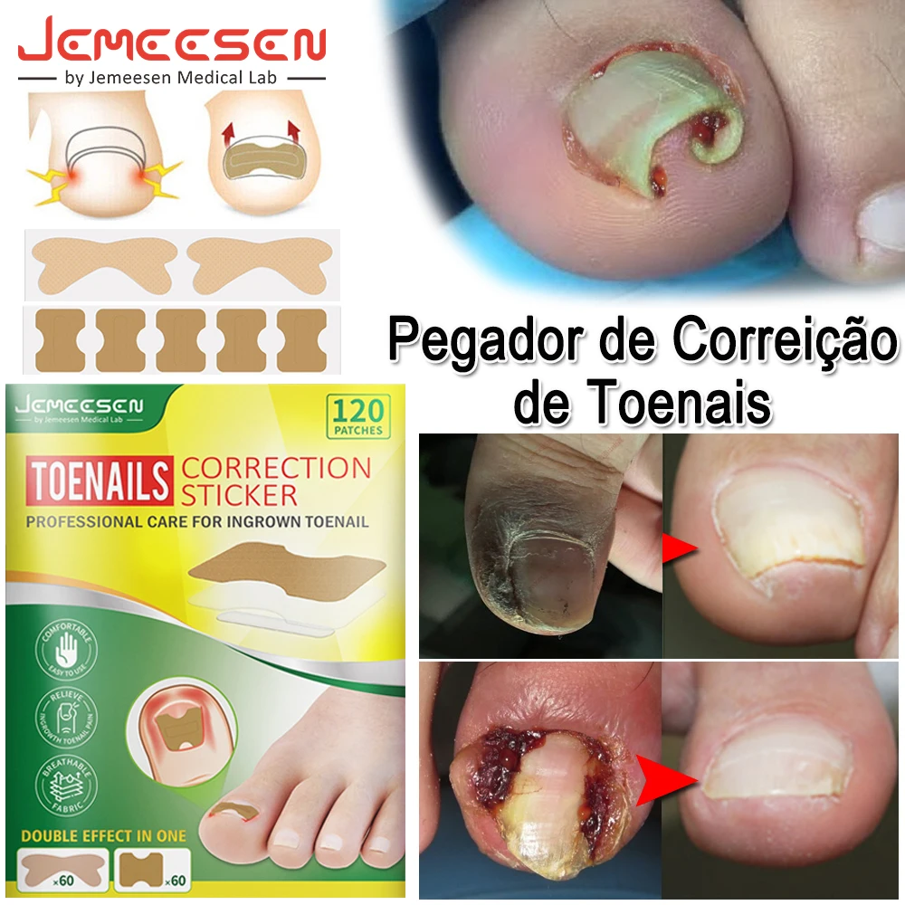 Ingrown-Toenail-Corrector-Patches-Corre-o-Adesivos-para-aliviar-as ...