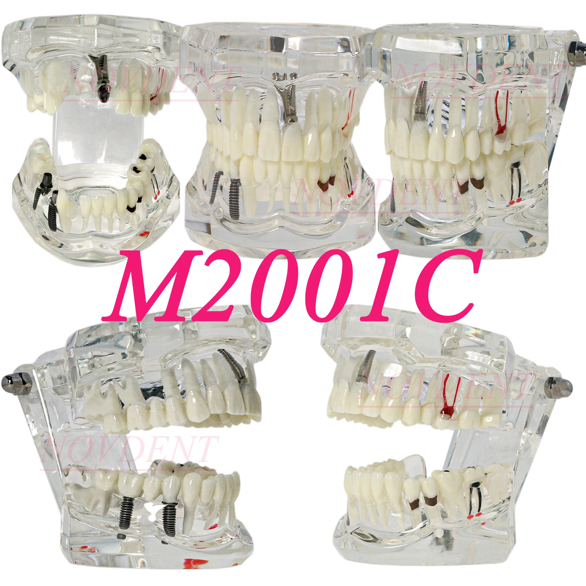 Dental-Implant-Restoration-Pathology-Teach-Study-Teeth-Model-M2001C ...