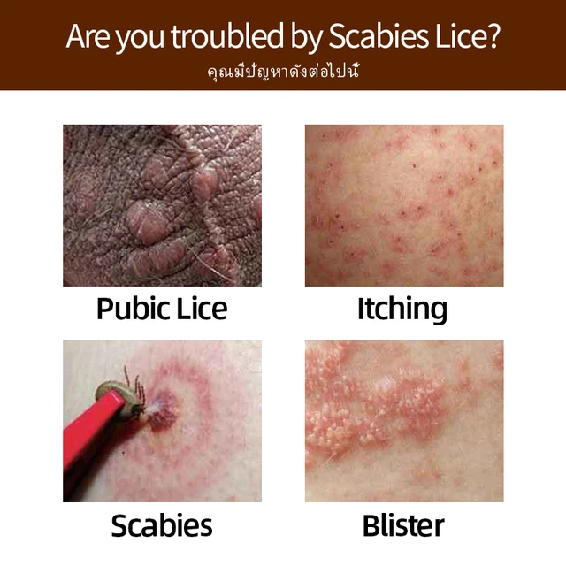 Scabies On Inner Thigh