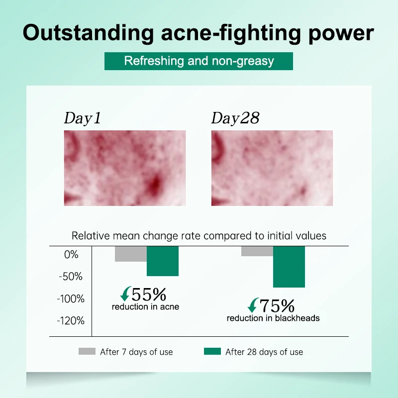 Acne Vulgaris Treatment Cream