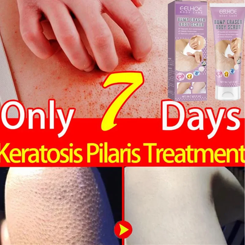 Keratosis-Pilaris-Creme-pflegende-Feuchtigkeit-creme-f-r-Erdbeer-beine ...