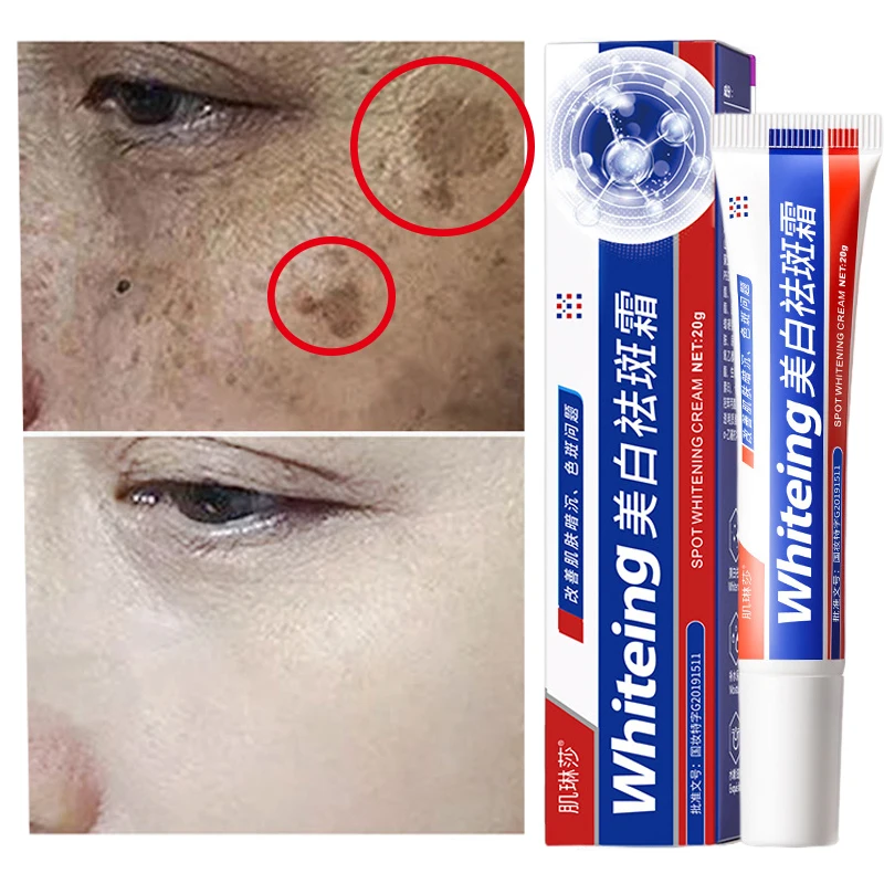 Whitening Freckle Face Cream Fade Dark Spots Melasma Melanin Pimple ...