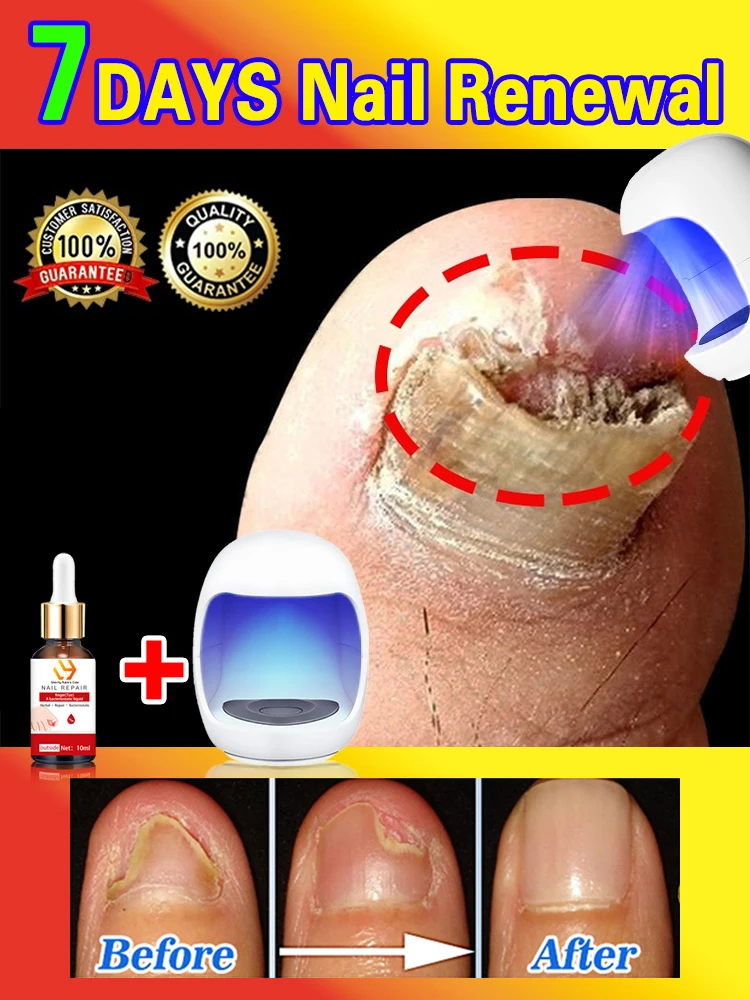 Laser-Product-To-Solves-Nail-troubles.jpg