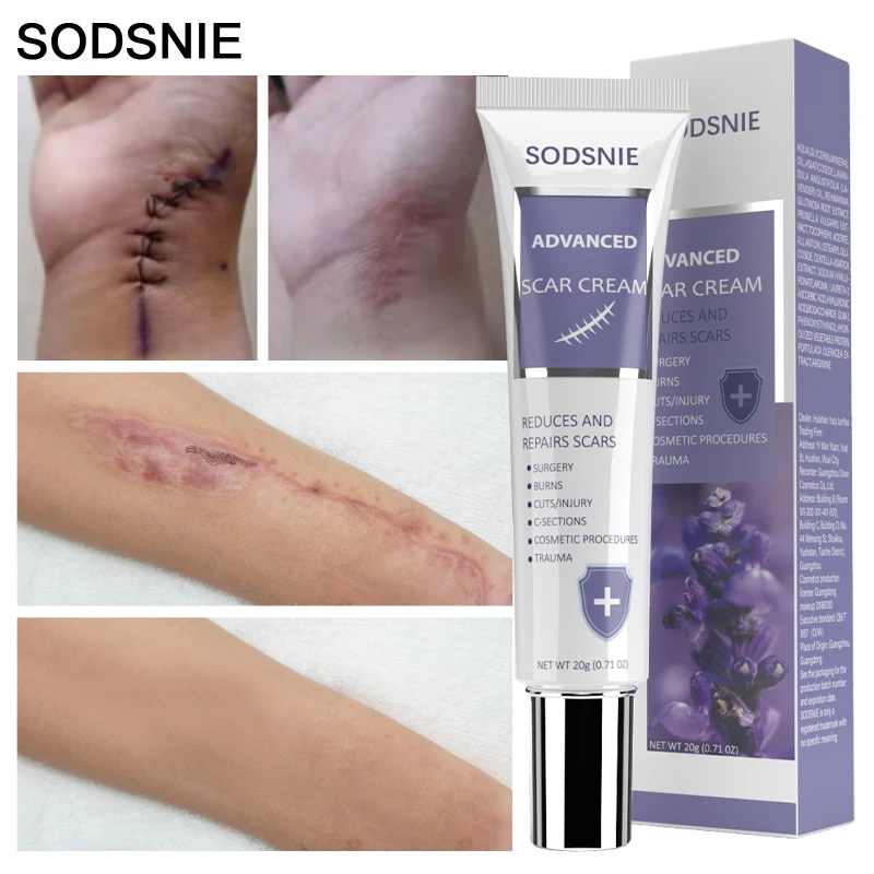Advanced-Scar-Cream-Remove-Stretch-Marks-Surgical-Scars-Burn-Repair ...