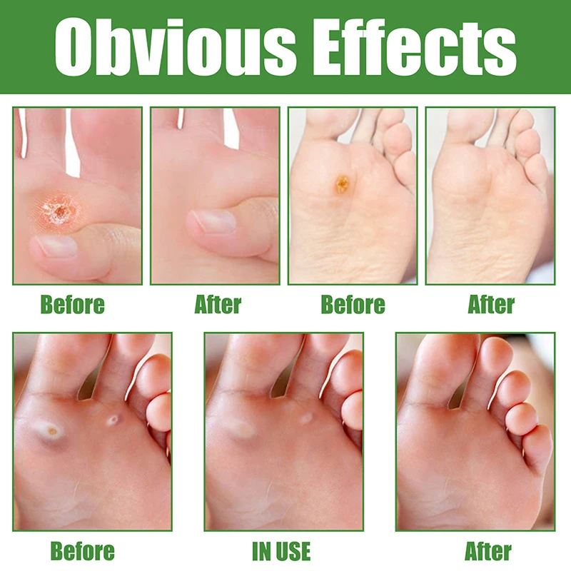 30Pcs-Medical-Corn-Plaster-Wart-Remover-Pads-Warts-Thorn-Killer-Plantar ...