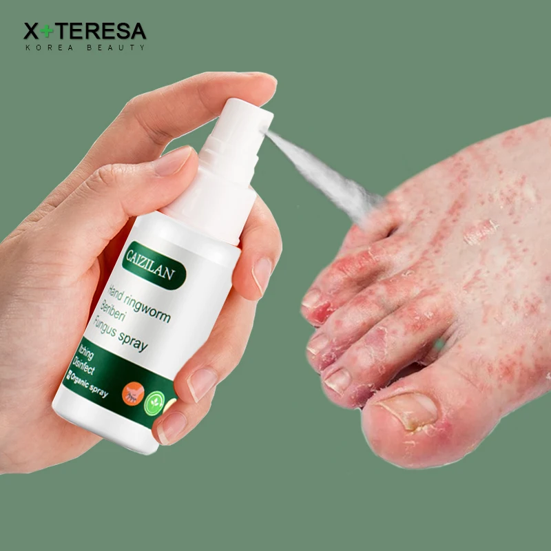 Fungal Combat Feet Spray Foot Sterilize Cream Herbal Anti fungal ...