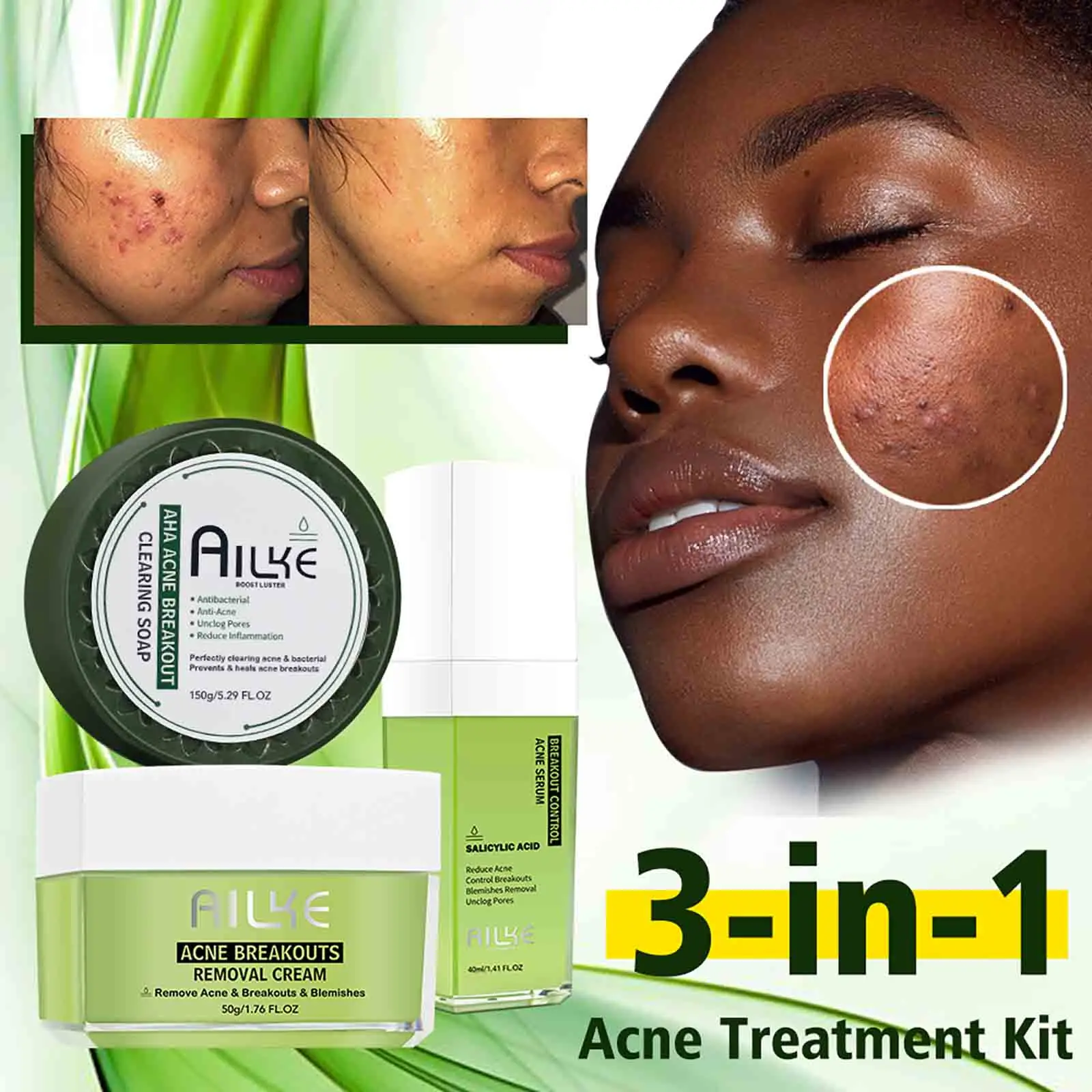 AILKE Natural Anti Acne Skin Care Range, Fast Beat Acne-prone Skin ...