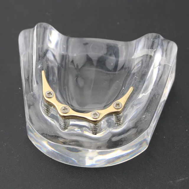 Implant Overdenture Model Dental Implant Demo Model M6008 – Lower Jaw ...