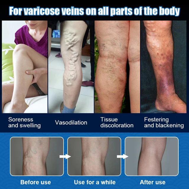 Varicocelectomy Scar