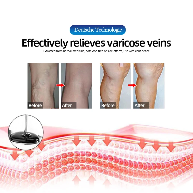 Vulvar Varicosities Treatment