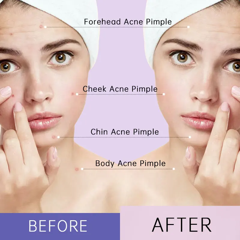 Concealer Before And After Pimple