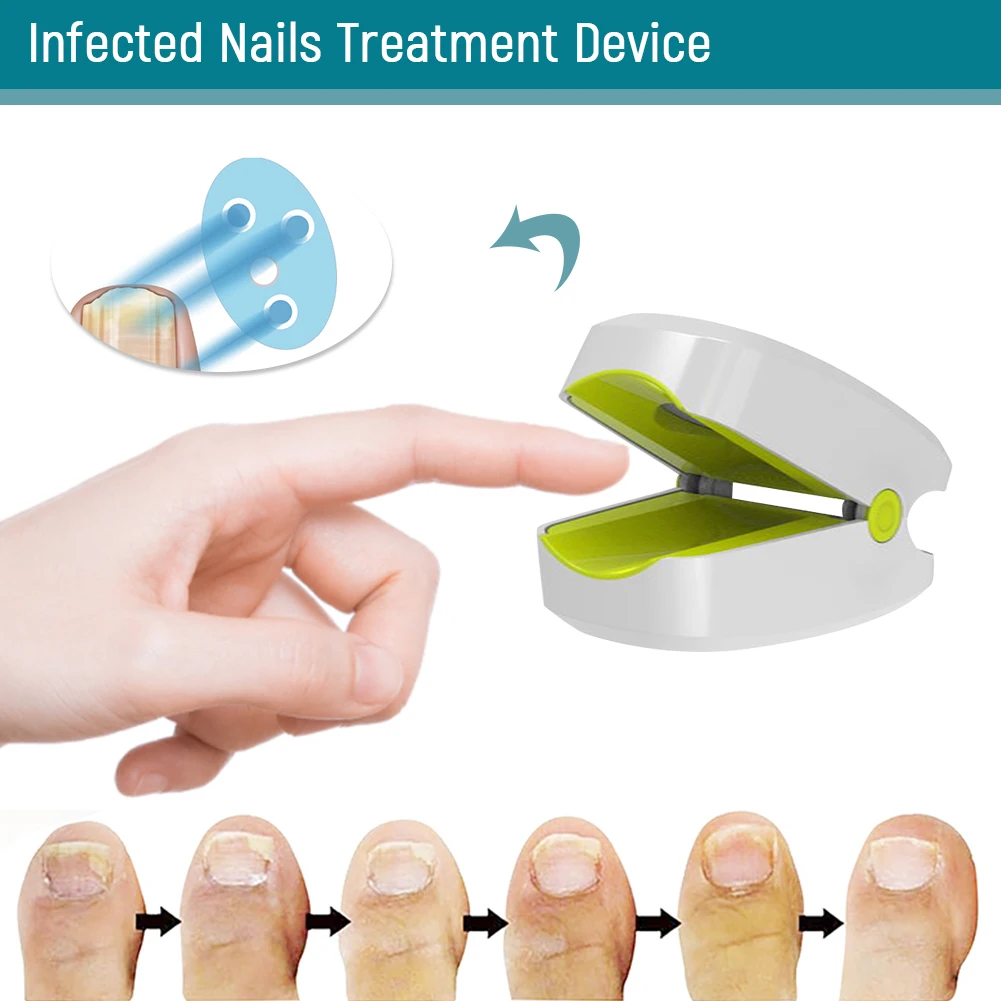 905nm-prego-fungo-tratamento-a-laser-dispositivo-22w-prego-mais-limpo-equipamento-terapia-dedo ...