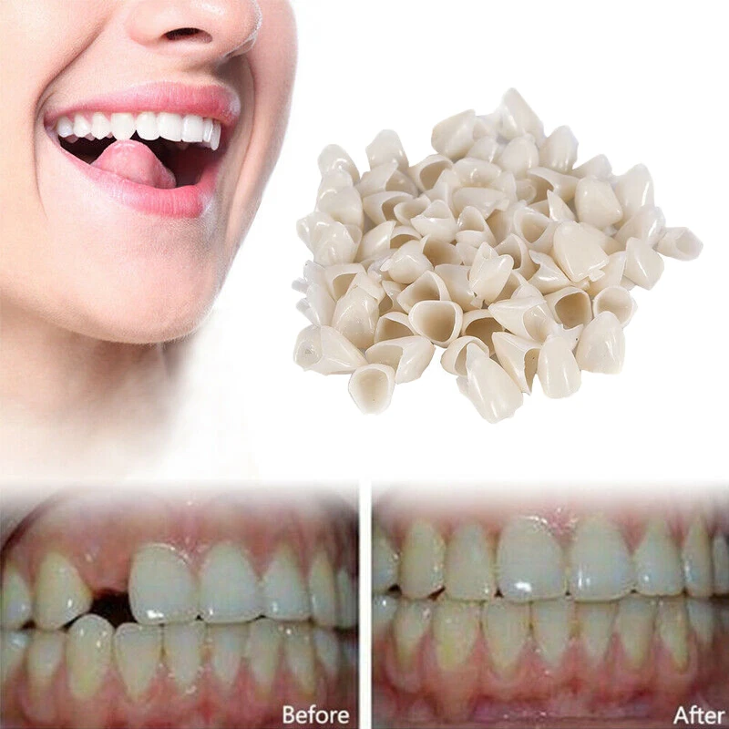 Temporary-Crowns-Posteriors-Anterior-Molar-Front-Back-Tooth-Teeth-Caps ...