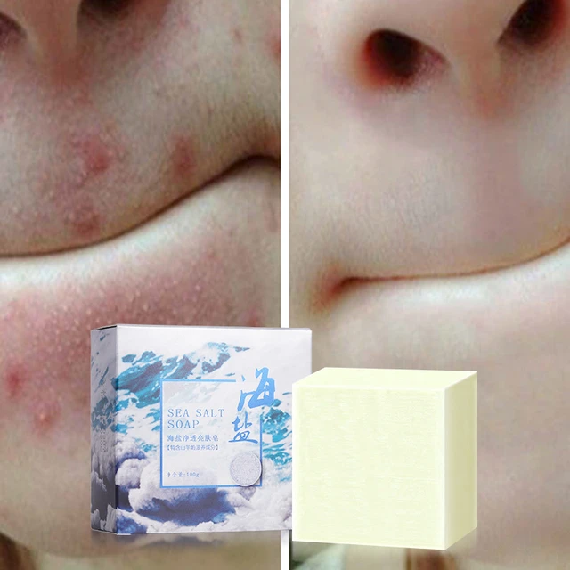 100g Sea Salt Soap To Remove Pimple Acne Treatment Oil And, 41% OFF