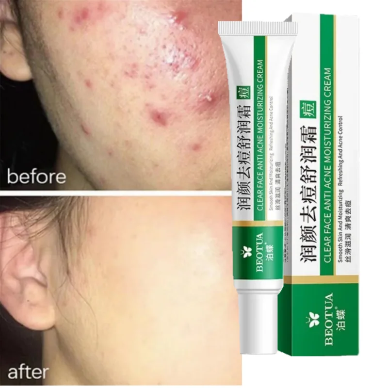 Herbal-Acne-Removal-Cream-Remover-Espinhas-Marcas-de-cicatriz-Pontos ...
