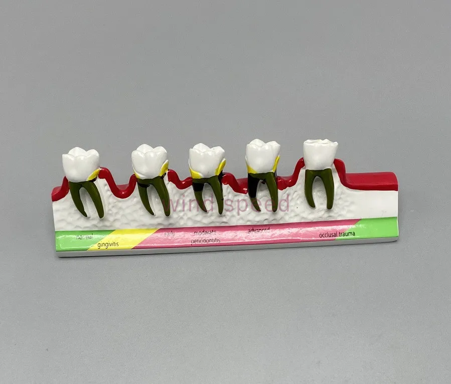Dental-Periodontal-Disease-Assort-Teeth-Dentoform-Models-Study-Teaching ...