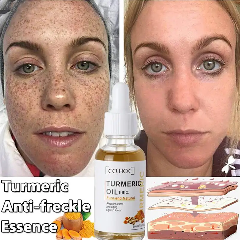 Turmeric-Whitening-Serum-Remove-Freckle-Dark-Spot-Melasma-Essential-Oil ...