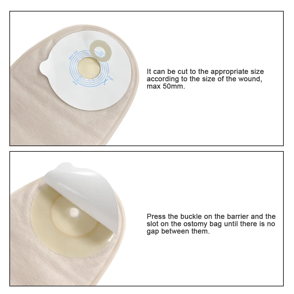 Ileostomy Bag Vs Colostomy Bag