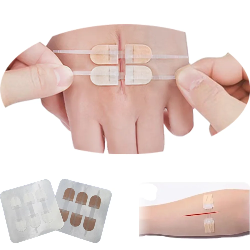 Tension Relief Zipper Bandage Stitch-Free Wound Closure Strip Self ...